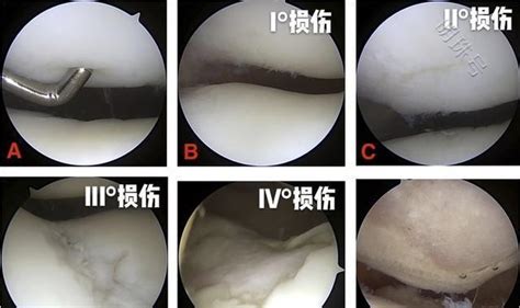 髌骨软骨软化会让您上下楼时疼痛酸胀该怎么控制参考下 关节骨头频道 东方养生