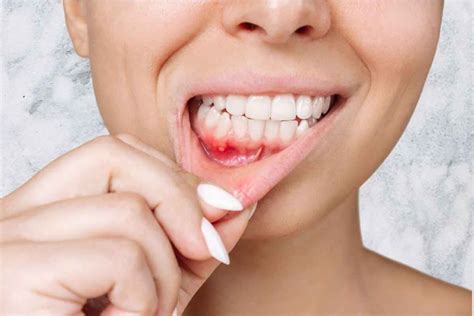 Early Stage Leukemia Bleeding Gums 7 Crucial Facts Liv Hospital