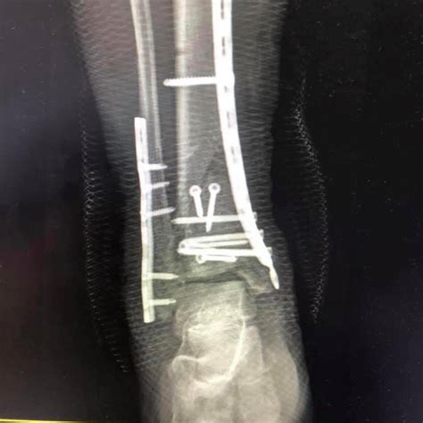 Внутрішньосуглобовий багатоуламковий перелом ДЕМ в гомілкової кістки зі