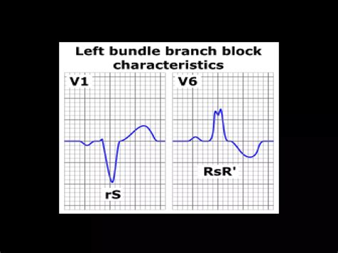 Bundle Branch Blocks PPT