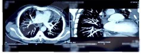 Ctpa Showing A Contrast Filling Defect In The Posterior Basal Segmental Download Scientific