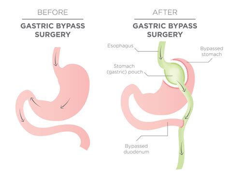 Gastric Sleeve Vs Gastric Bypass What Are The Pros And Cons
