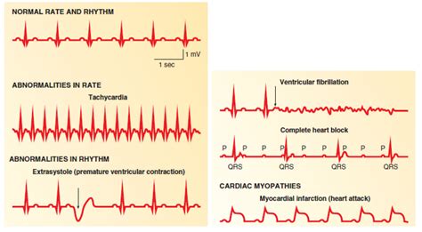 Abnormal Ecg Labeled