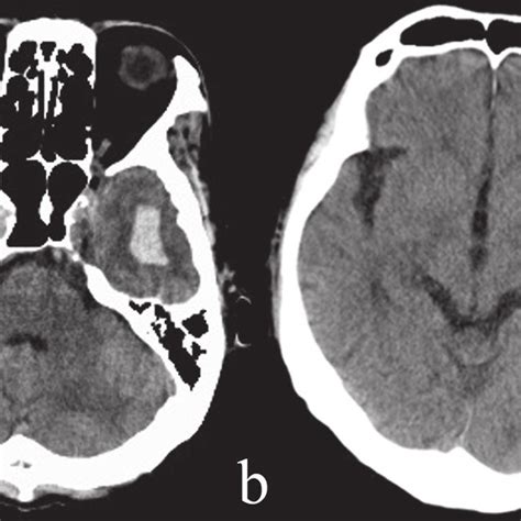 Classification According To Borden Et Al 5 And Cognard Et Al 6 Of