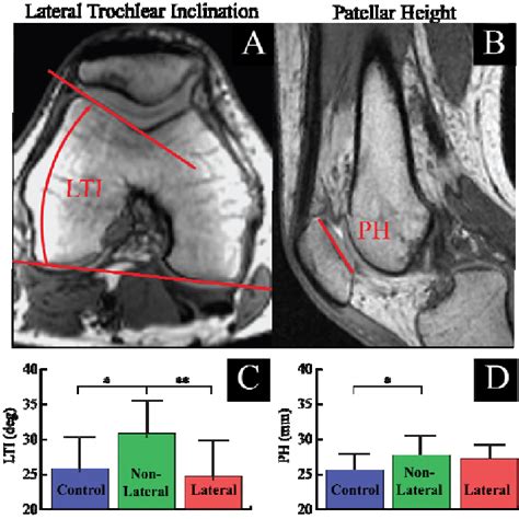 A Lateral Trochlear Inclination Angle The Angle Between The Lateral Download Scientific