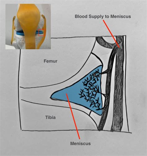 What Is A Meniscus Tear Quay Health