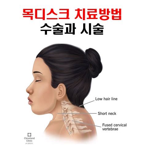 목디스크 수술과 시술 치료방법 언제해야할까