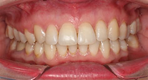 Ii Class And Deep Bite Correction In Adult Patient сases Of The Polar