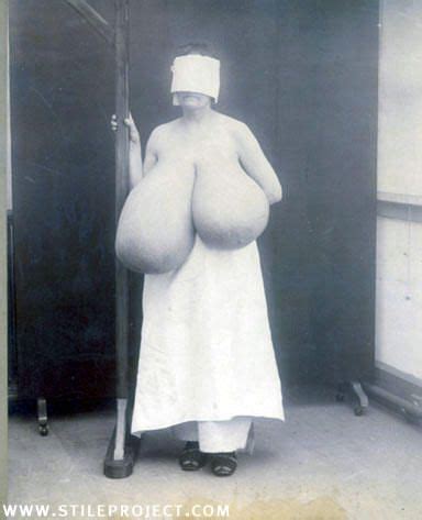 Clinical Gigantomastia Cumception