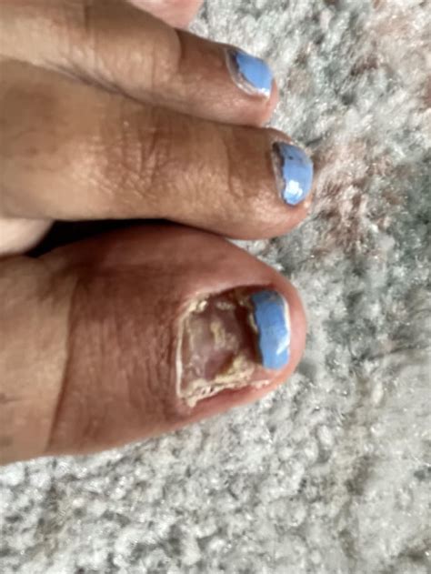 Trigger Alert My Toenail Just Came Off Is It Another Symptom Of My Pof Rpoflife
