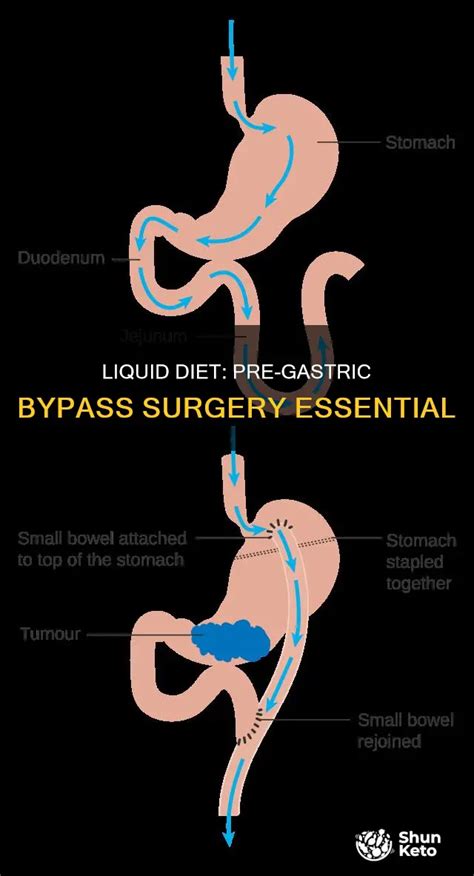 Liquid Diet Pre Gastric Bypass Surgery Essential Shunketo