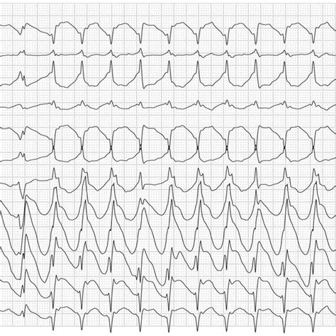 Ecg After 1 Month Showed That Corrected Qt Interval Had Returned To