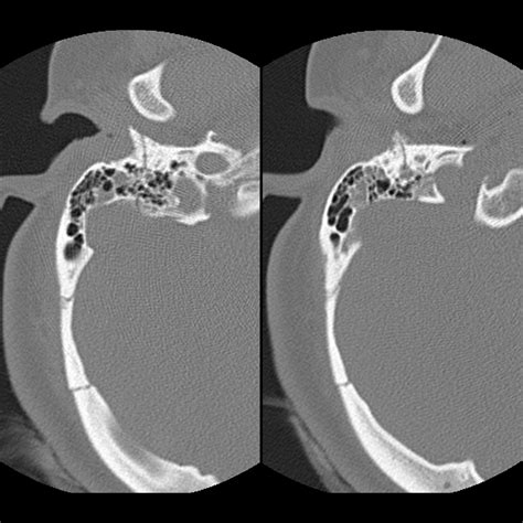 Pediatric Temporal Bone Fracture Pediatric Radiology Reference Article Pediatric Imaging