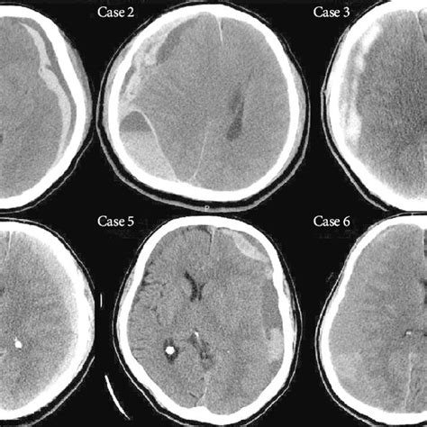 Preoperative Ct Scans Of The Acute On Chronic Subdural Hematoma Case 7