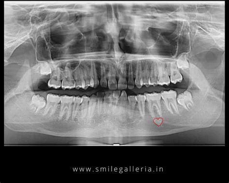 Happy Valentines Day 🌹 Tooth Root ♥️ Bone Island Here We Present The Case Referred To Our