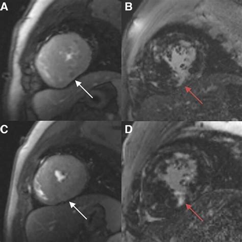 Myocardial Perfusion Examination A C Demonstrating A Perfusion Download Scientific Diagram