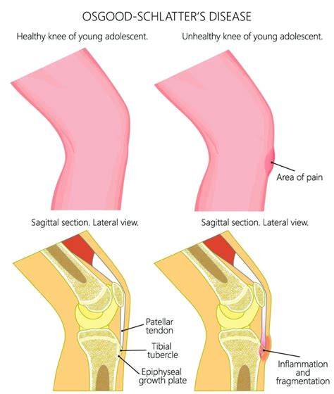 Osgood Schlatter Disease Managing And Preventing Pain