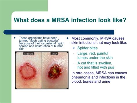 Mrsa Ppt Ppt