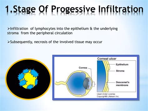 Approach To Microbial Keratitis 1 Pptx
