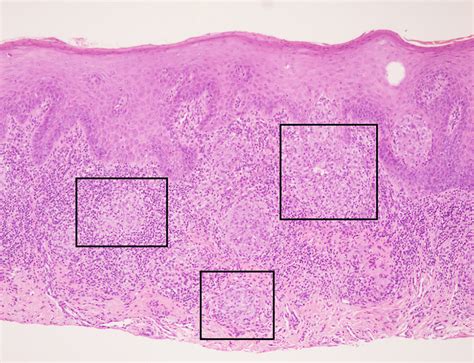 Histological Section Of Lower Lip Lesion On Medium Power Tight Download High Quality