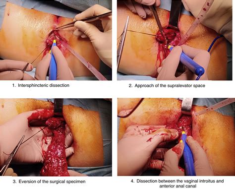 Proctectomy Perineal