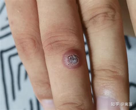 陪男朋友治疗手疣的全过程记录 知乎