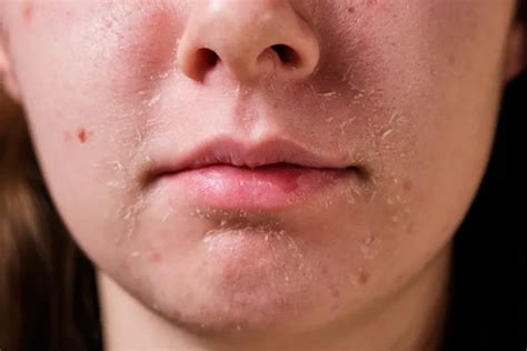 The Ultimate Guide To Coping With Dry Skin Causes Treatments And