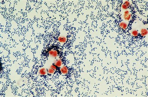 Streptococcus Pneumoniae Gram Stain