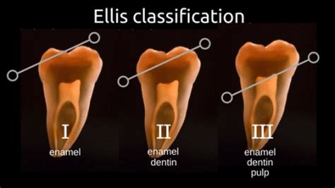 Ellis Classification For Tooth Fracture News Dentagama