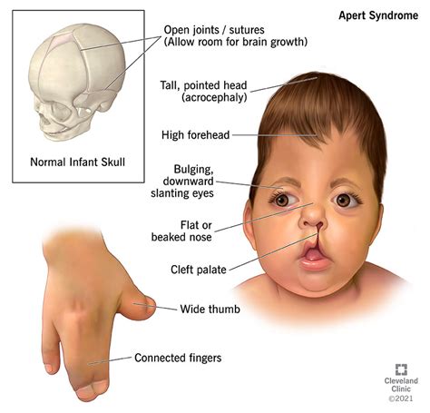 Understanding Apert Syndrome Causes Symptoms And Treatment Options