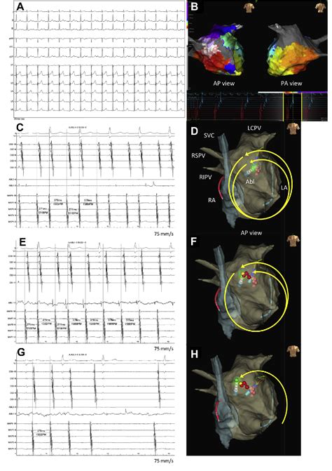 Figure 2 From Atrial Flutter With Alternating Tachycardia Cycle Length After Atrial Fibrillation