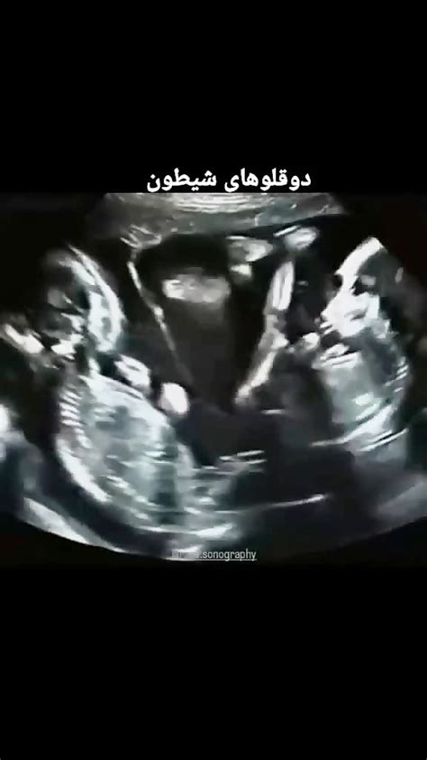 سونوگرافی بارداری دوقلو
