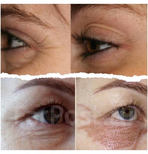 Подтяжка Груди Без Операции Smas Лифтинг 4d Мед Академия во Владивостоке