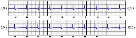 Safety And Performance Of The Subcutaneous Implantable Cardioverter