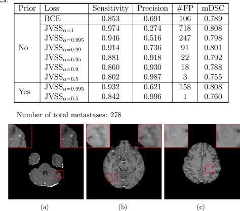 deep learning for brain metastasis detection and segmentation in