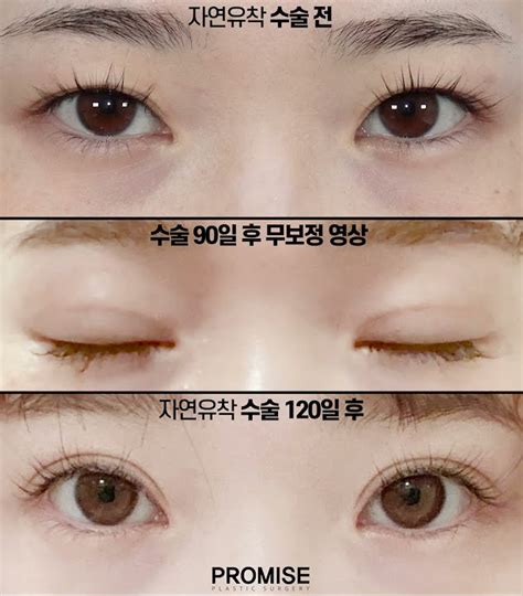 화려한 아웃라인 쌍수 무보정 경과영상 🥙 프라미스성형외과 Shorts Youtube