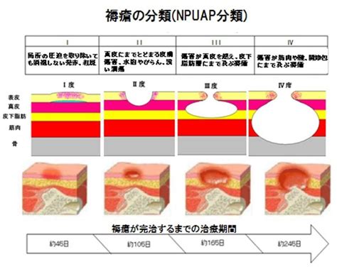 褥瘡発生 「圧力ー時間」の関係 ゴニオメーターならサンハロー