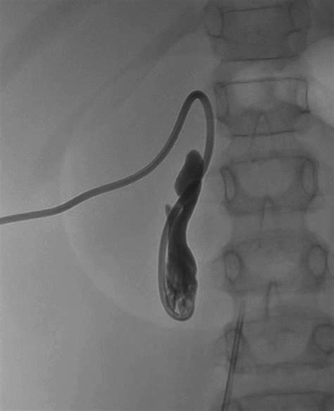 Acute Acalculous Cholecystitis Applied Radiology
