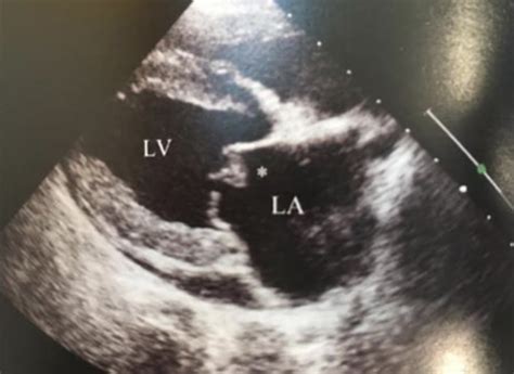 Echocardiogram Flashcards Quizlet