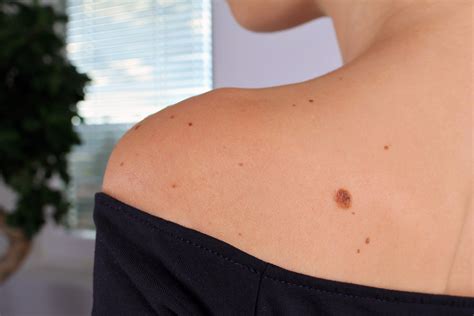 3 Types Of Skin Moles