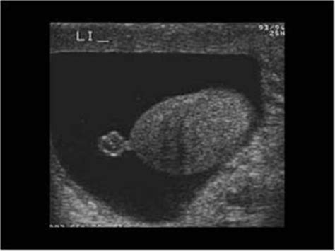 Urinary Tract And Male Reproductive System 2 3 Scrotum Case 2 3 1
