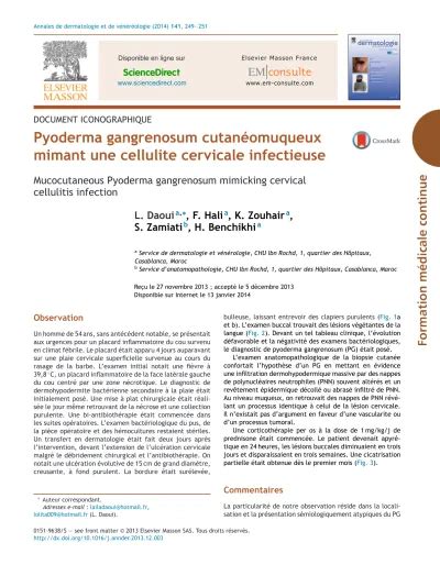 Mucocutaneous Pyoderma Gangrenosum Mimicking Cervical Cellulitis Infection [pyoderma Gangrenosum