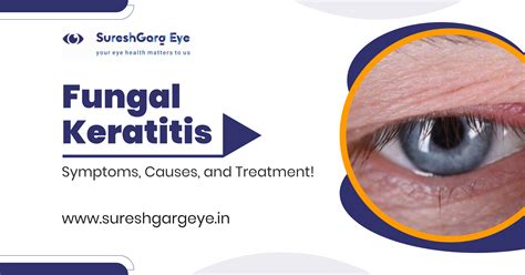 Fungal Keratitis Guidelines At Brodie Parkhill Blog