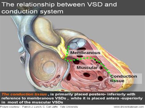 How Does Vsd Affect The Conduction System Of Heart Which Is Dangerously Close To It Dr S
