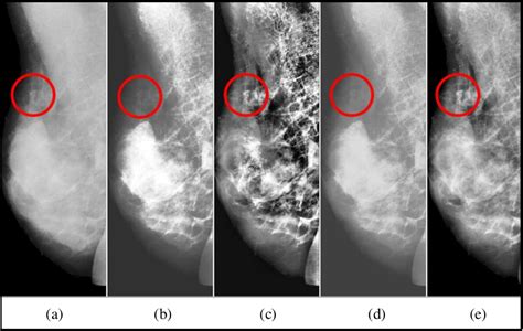 Figure 1 From Enhancing Detection Of Microcalcifications Using Fadhecal For Early Stage Breast