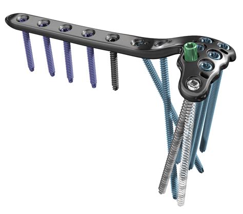Alps® Proximal Tibia Plating System