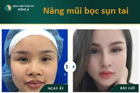 Nâng Mũi Sụn Tai đặc điểm Bảng Giá And Quá Trình Thực Hiện 2022