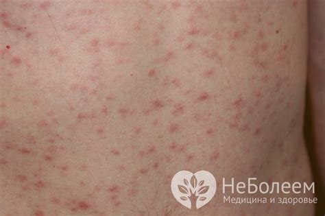 Сифилис у мужчин симптомы признаки