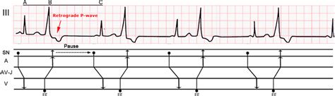 Sinus Rhythm And Ventricular Extrasystoles Download Scientific Diagram