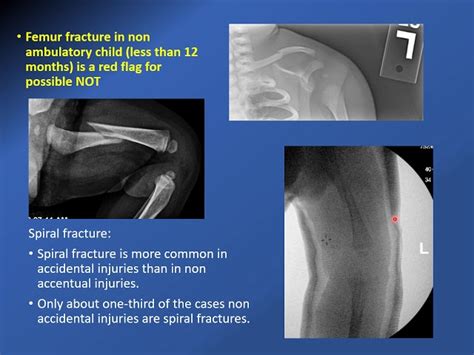 Spiral Fracture Femur